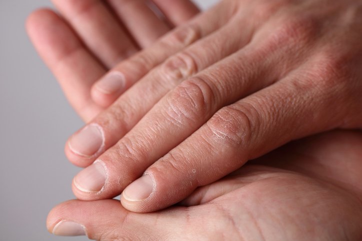 What Causes Chilblains & How to Prevent Them | Chroma Dermatology