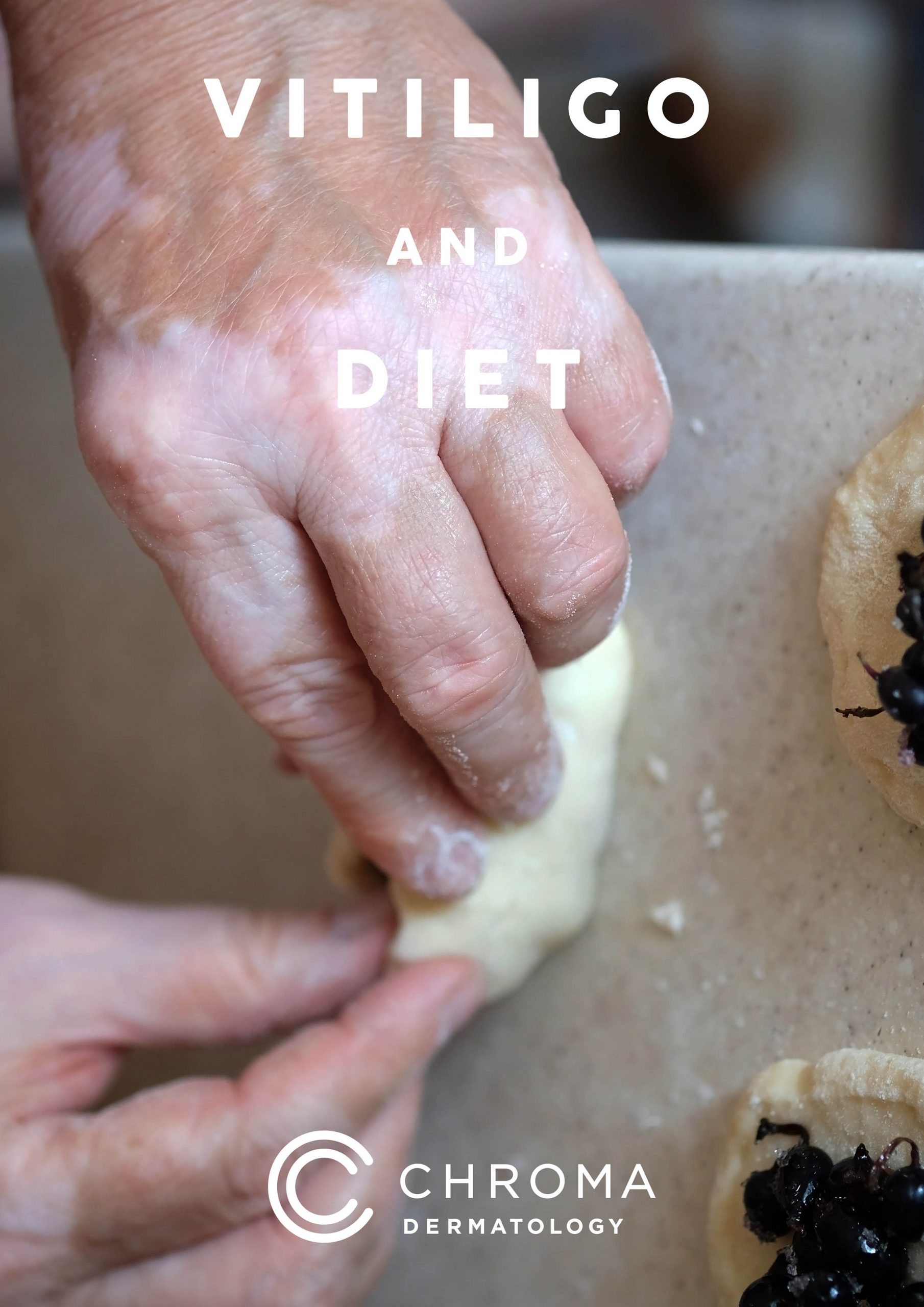 Foods to Avoid and Supplements & Vitamins to help Vitiligo