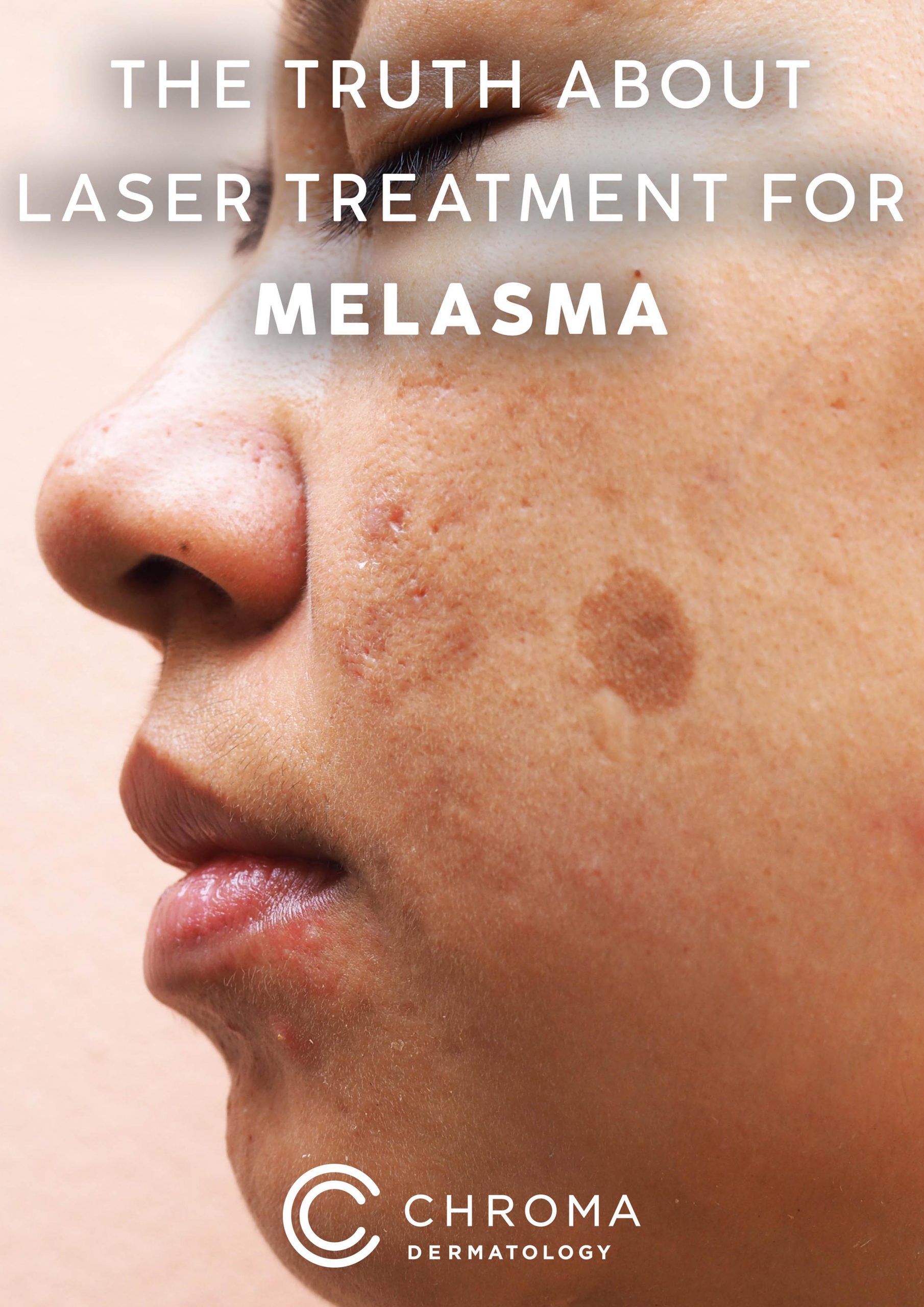 The Truth About Laser Treatment For Melasma | Chroma Dermatology