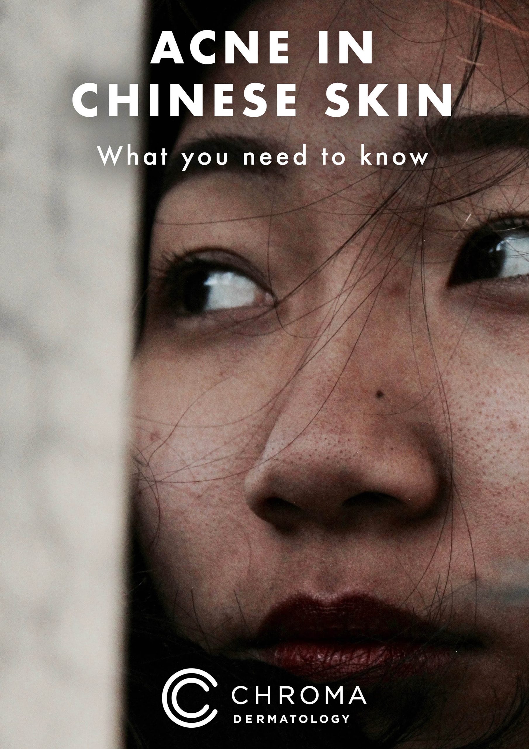 All you Need to Know about Acne in Chinese Skin | Blog | Chroma