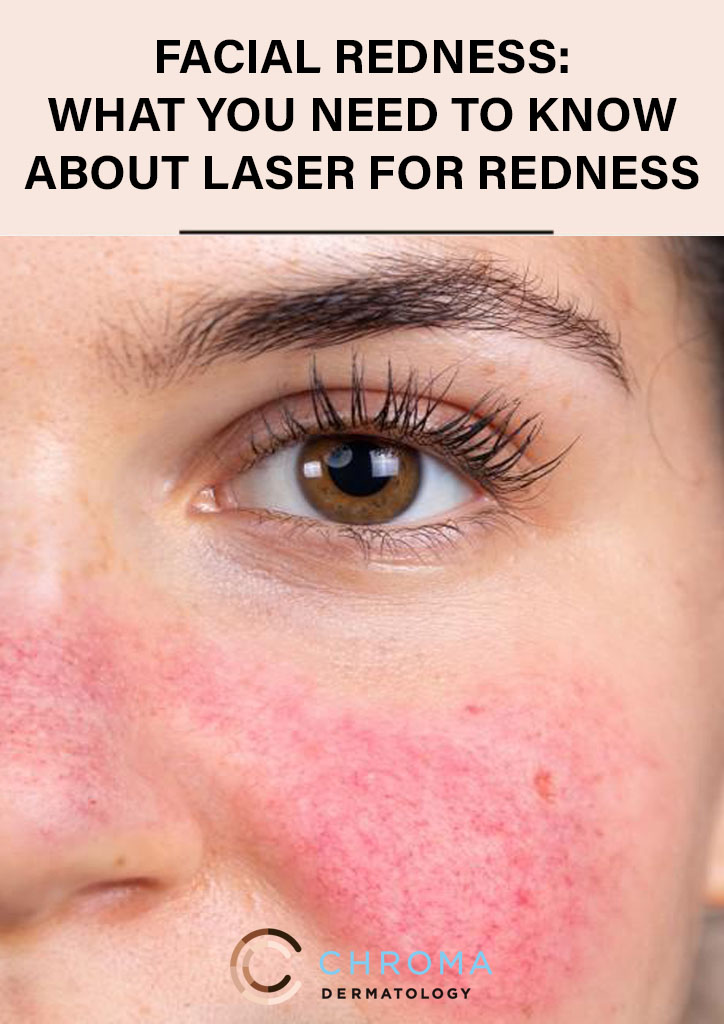 Laser Treatment for Redness: What to Know - Chroma Derm