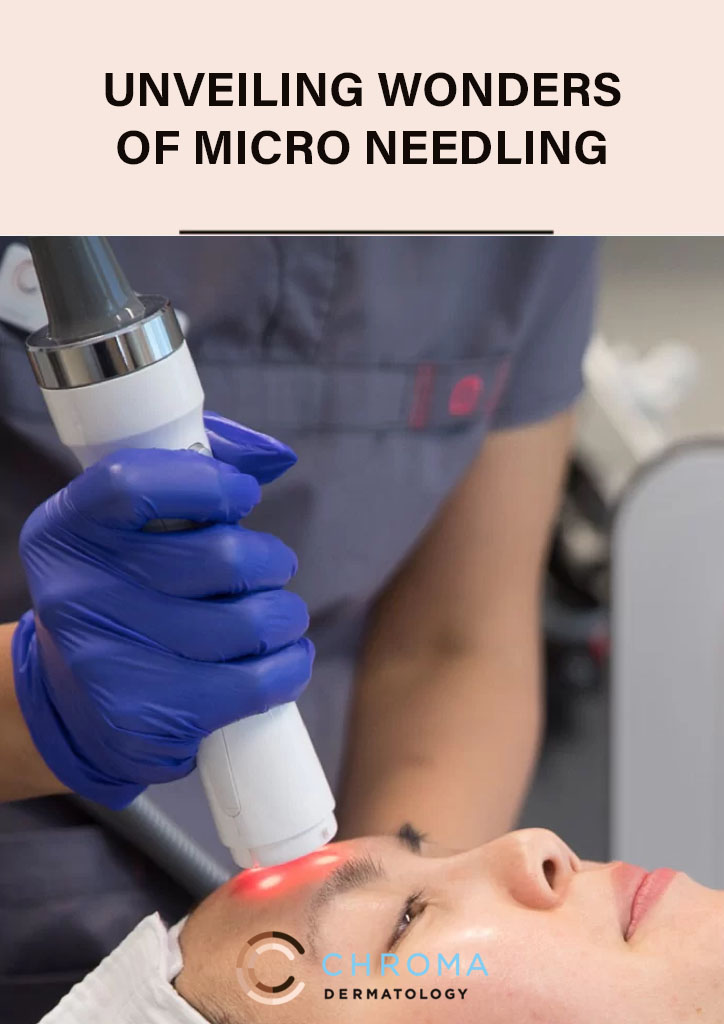 Microneedling for Skin Rejuvenation - Chroma Derm