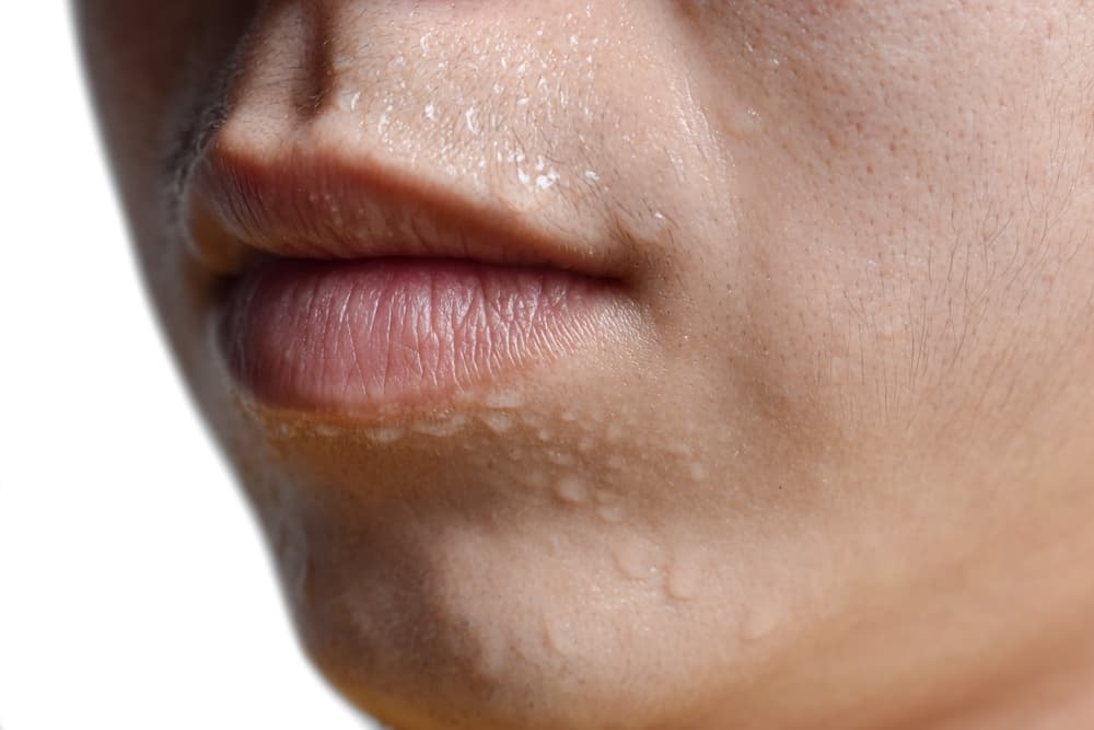 What Causes Excessive Sweating of the Head and Face | Chromaderm