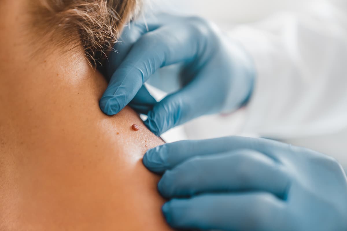 Rapid Access Skin Mole Check Clinic – Chroma Dermatology